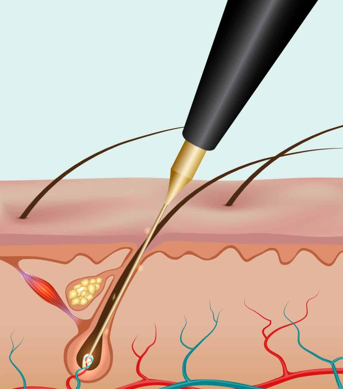 Épilation Définitive - La Belle et la Griffe